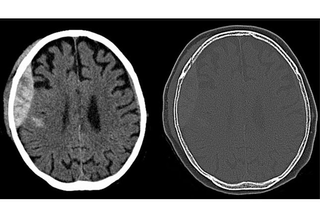 7 Potentially Devastating Traumatic Brain Injuries