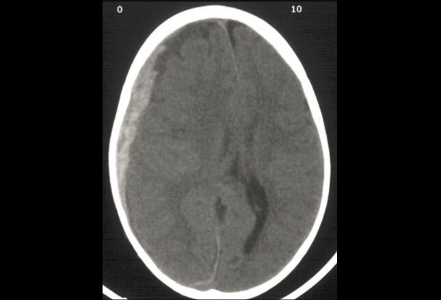 7 Potentially Devastating Traumatic Brain Injuries