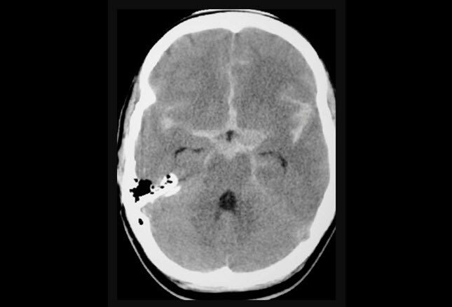 7 Potentially Devastating Traumatic Brain Injuries