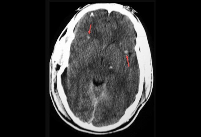 7 Potentially Devastating Traumatic Brain Injuries