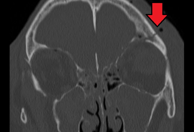 7 Potentially Devastating Traumatic Brain Injuries