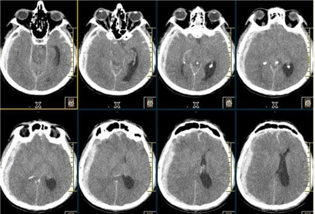 7 Potentially Devastating Traumatic Brain Injuries
