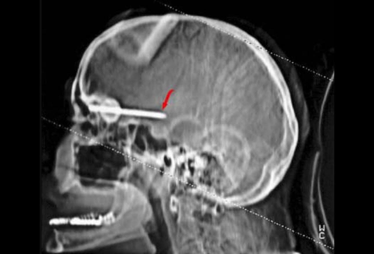 7 Potentially Devastating Traumatic Brain Injuries