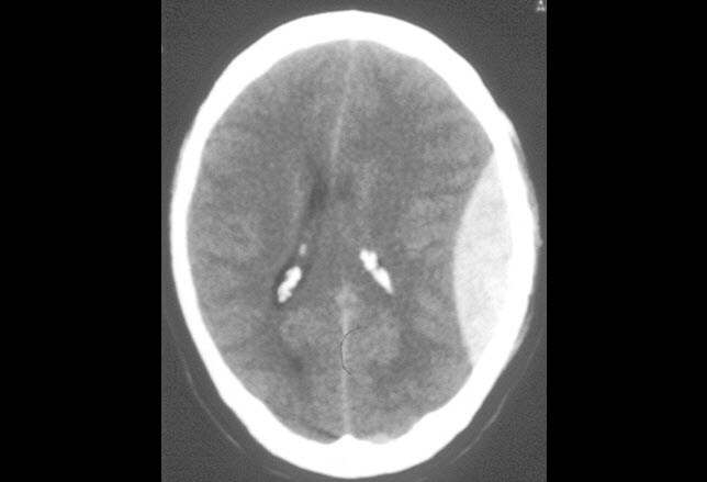 7 Potentially Devastating Traumatic Brain Injuries