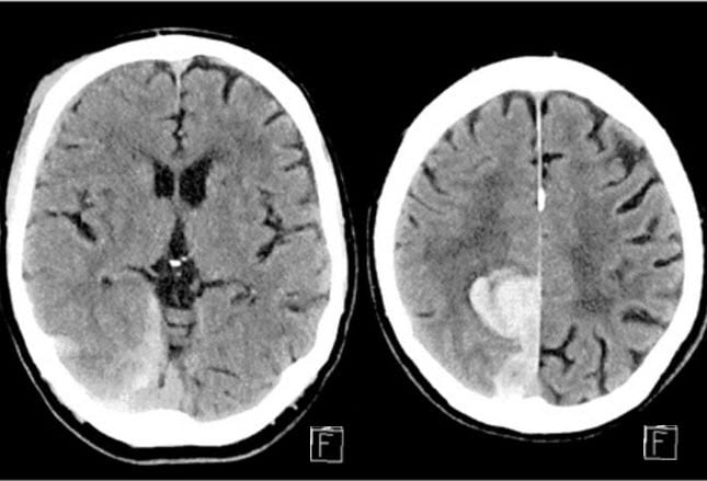Seven Potentially Devastating Traumatic Brain Injuries