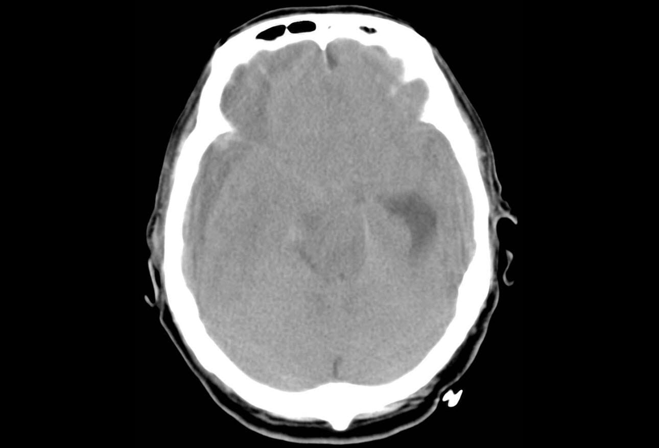 Seven Potentially Devastating Traumatic Brain Injuries