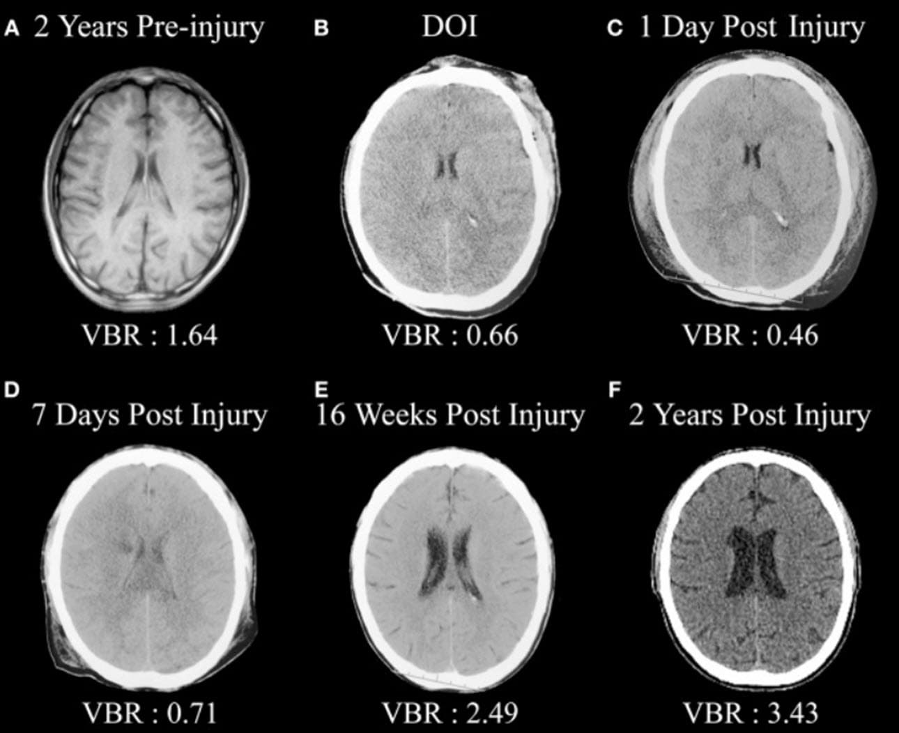 Seven Potentially Devastating Traumatic Brain Injuries