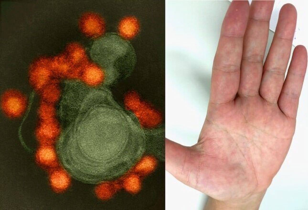 11 Travel Diseases You Need to Know