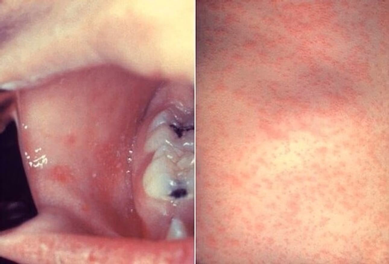11 Travel Diseases You Need to Know