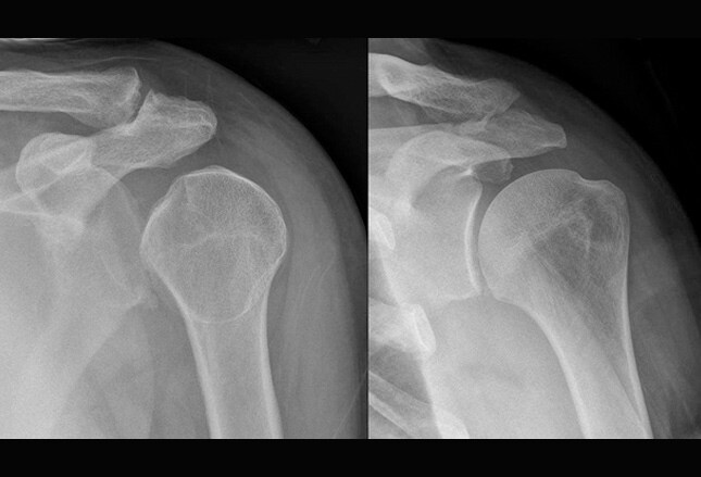 Best Practices: Successful Reduction Techniques for Upper Extremity ...