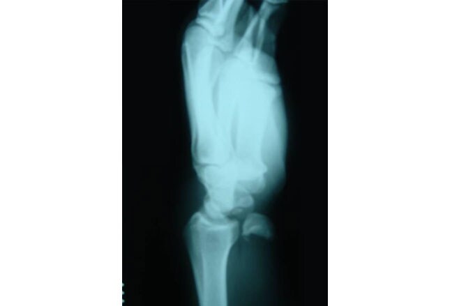 Best Practices: Successful Reduction Techniques for Upper Extremity ...