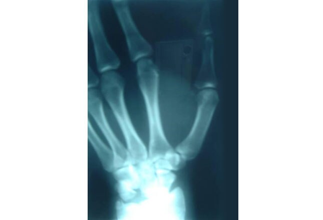 Best Practices: Successful Reduction Techniques for Upper Extremity ...