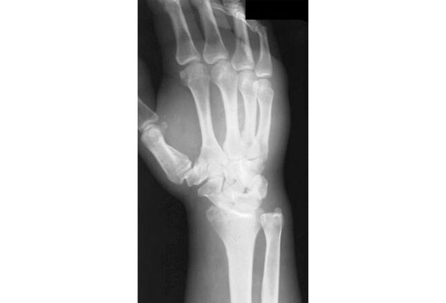 Best Practices: Successful Reduction Techniques for Upper Extremity ...