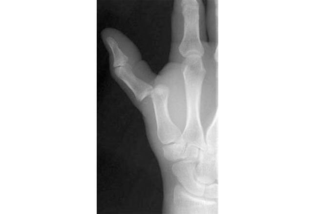 Best Practices: Successful Reduction Techniques for Upper Extremity ...