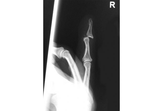 Best Practices: Successful Reduction Techniques for Upper Extremity ...
