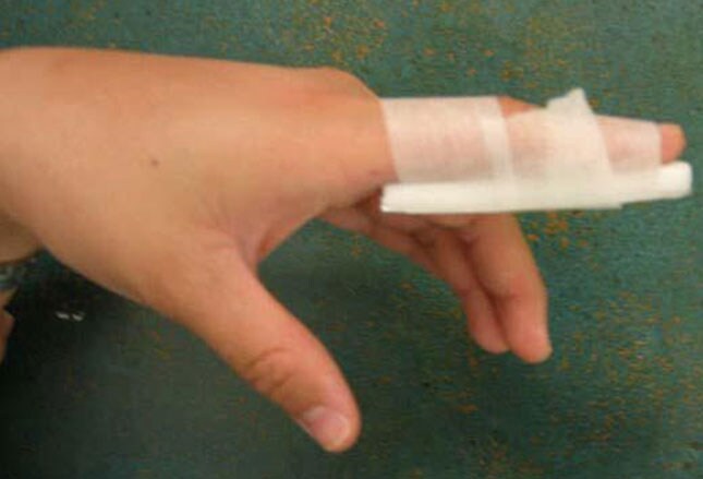 Best Practices: Successful Reduction Techniques for Upper Extremity ...