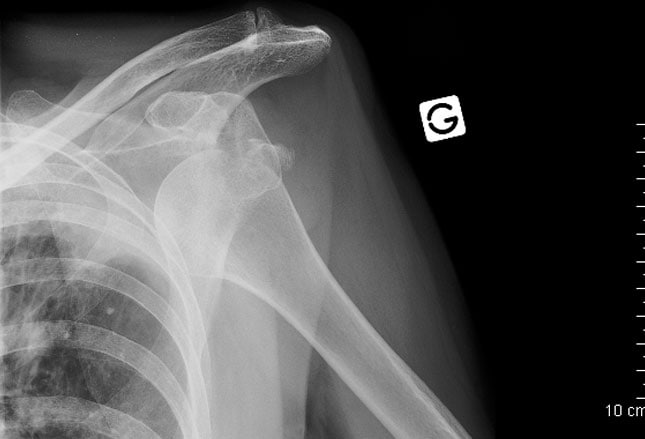 Best Practices: Successful Reduction Techniques for Upper Extremity ...