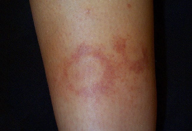 Untouchables: 9 Invertebrate Contact Defenses