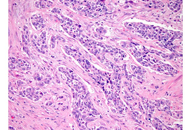 Urinary Bladder Cancer: What You Need to Know