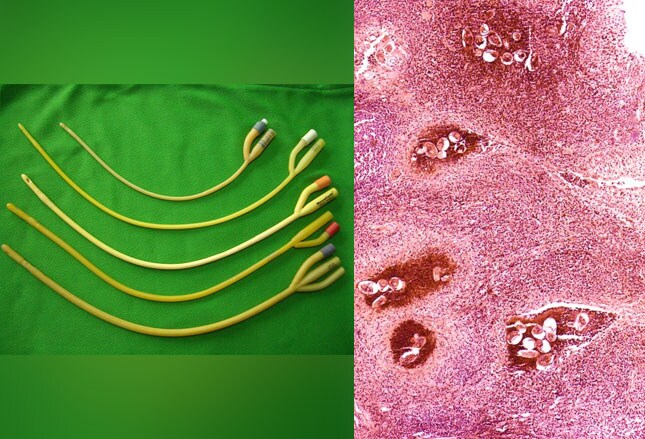 Urinary Bladder Cancer: What You Need to Know