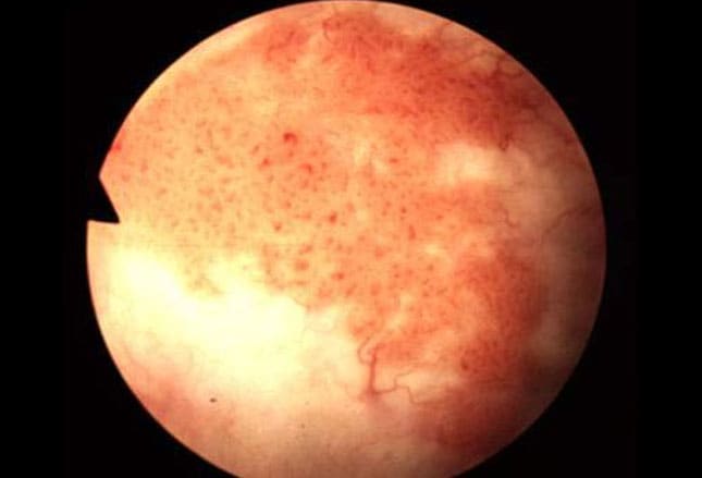 Urinary Bladder Cancer: What You Need to Know