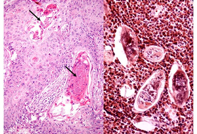 Urinary Bladder Cancer: What You Need to Know