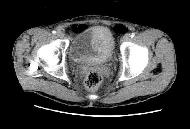 Urinary Bladder Cancer: What You Need to Know