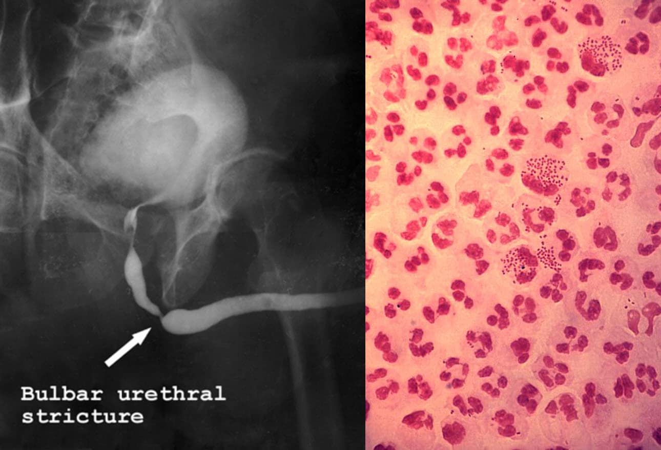 Urinary Tract Infections: A Spectrum of Pathologies and Challenges