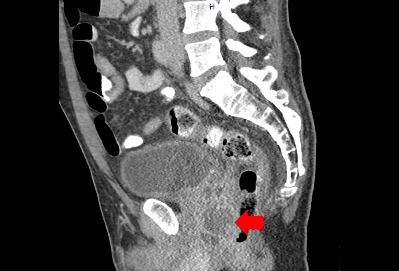 Urinary Tract Infections: Pathologies and Challenges