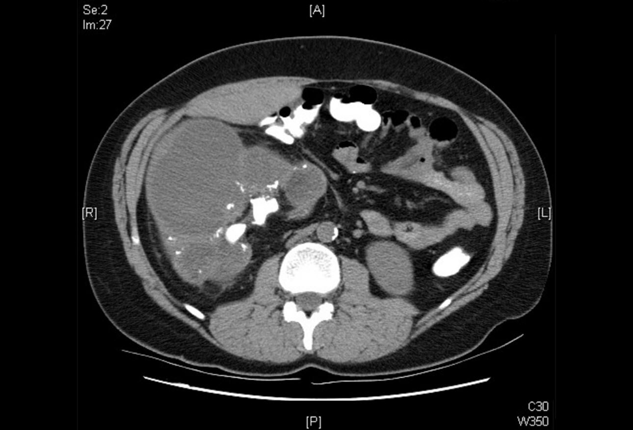 Urinary Tract Infections: Pathologies and Challenges
