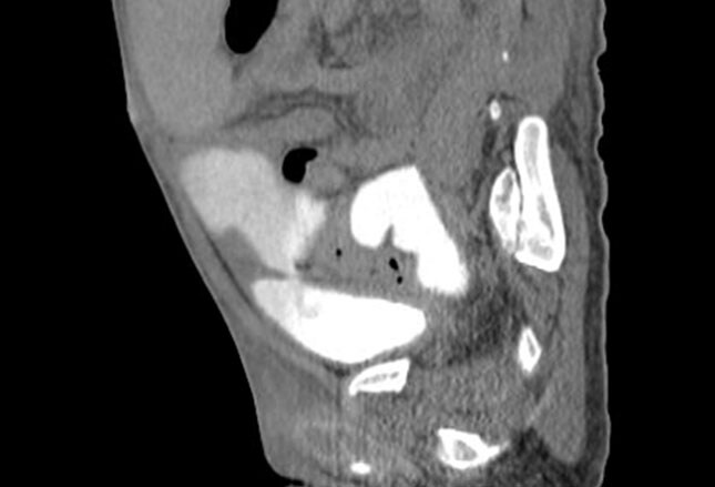 11 Urologic Emergencies You Need to Know