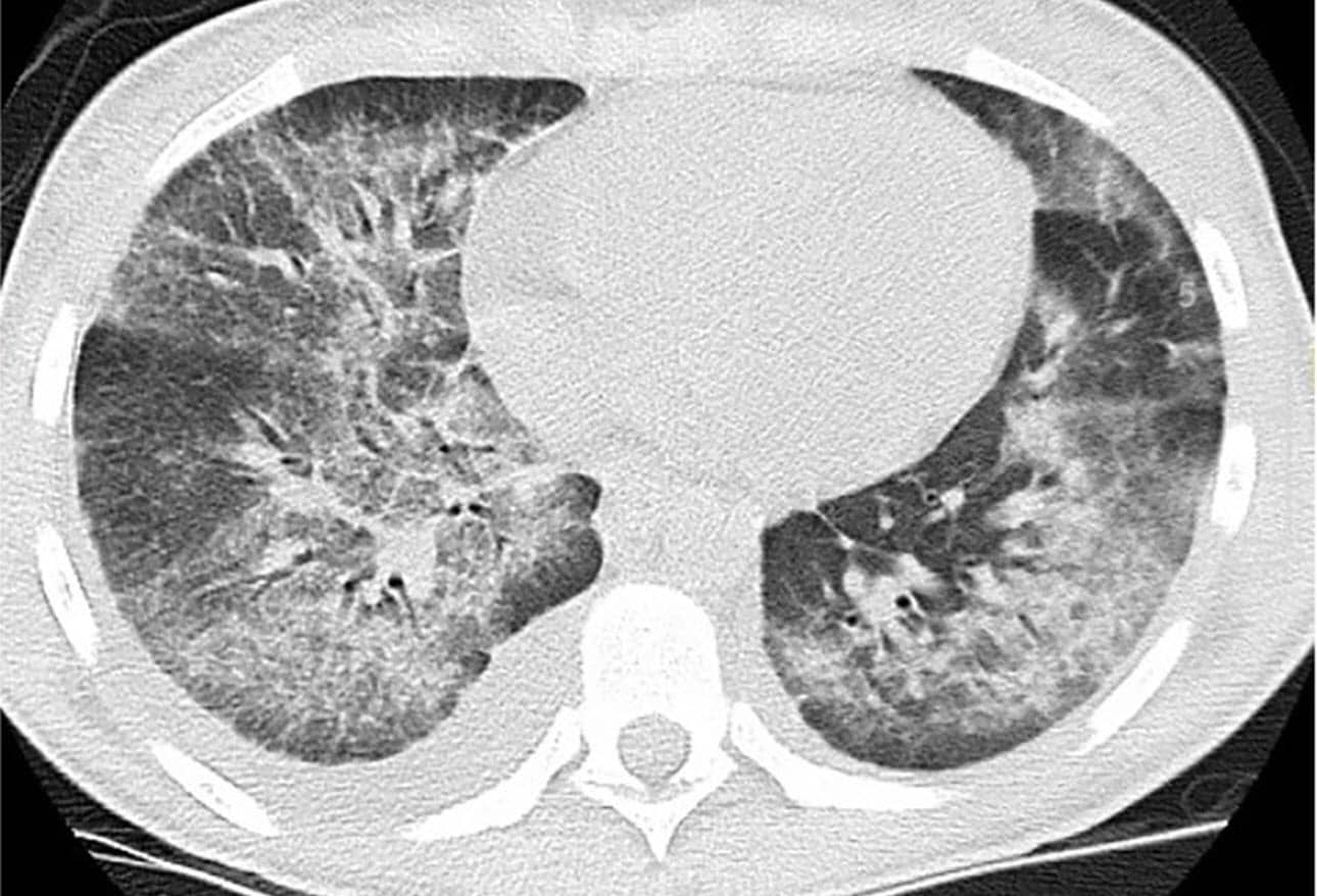 E-cigarette or Vaping Product Use-Associated Lung Injury (EVALI): A ...