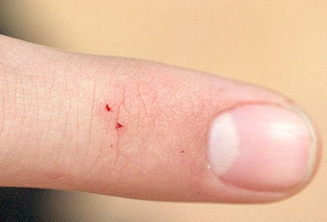 Medically Significant Spider Bites: Which to Watch Out For