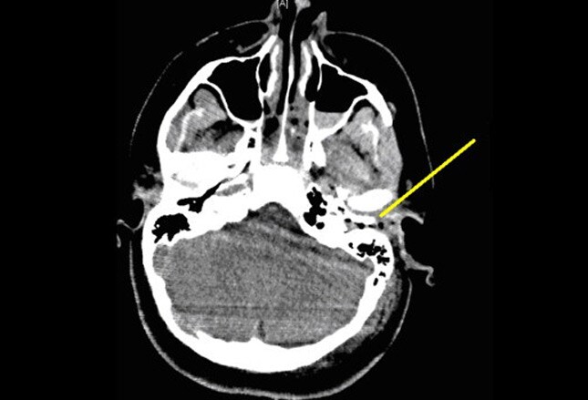 Vertigo: Identifying the Hidden Cause