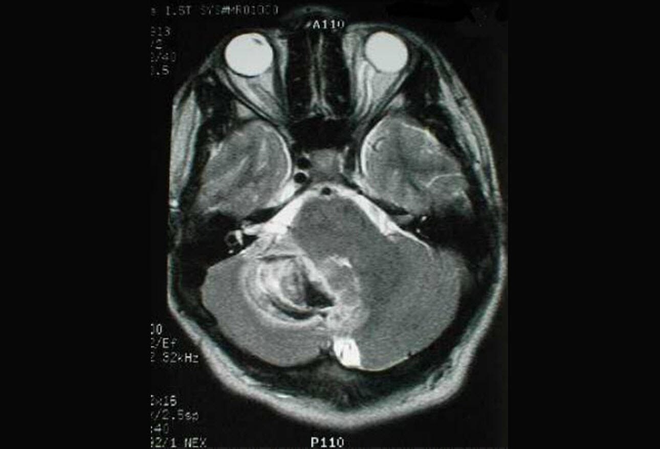 Vertigo: Identifying the Hidden Cause