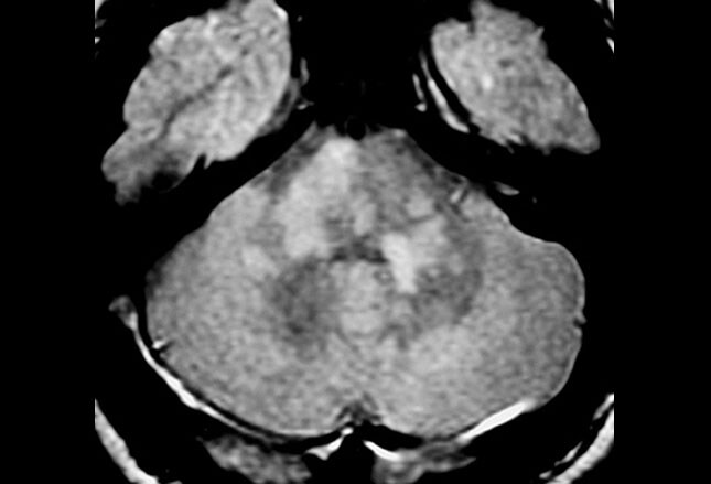 Vertigo: Identifying the Hidden Cause