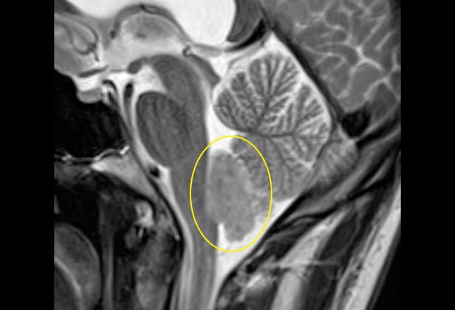 Vertigo: Identifying the Hidden Cause