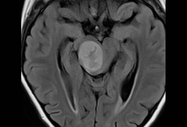 Vertigo: Identifying the Hidden Cause