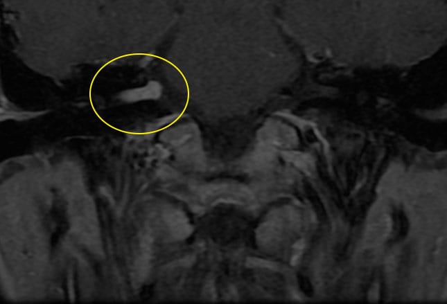 Central Vertigo: Identifying the Hidden Cause