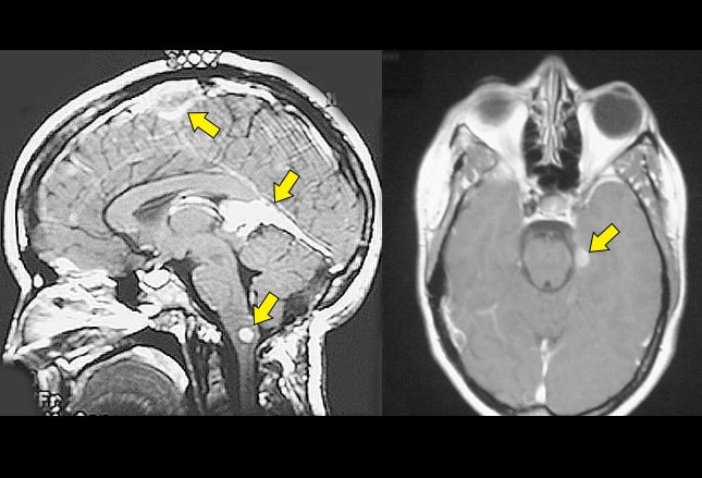 Central Vertigo: Identifying the Hidden Cause