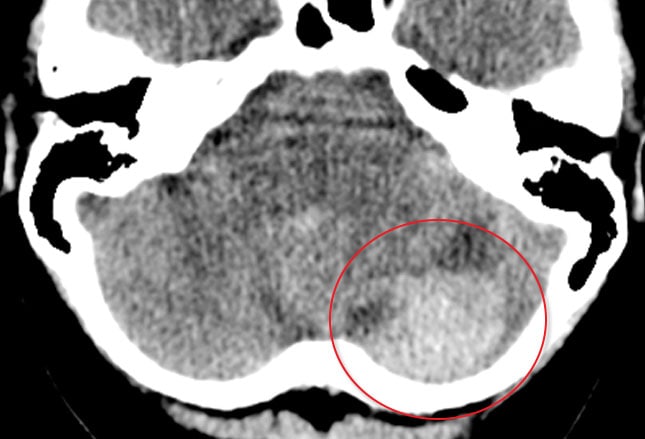 Central Vertigo: Identifying the Hidden Cause
