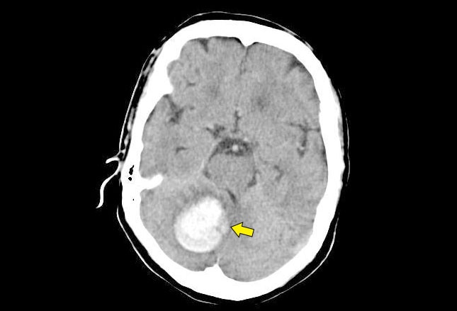 Central Vertigo: Identifying the Hidden Cause