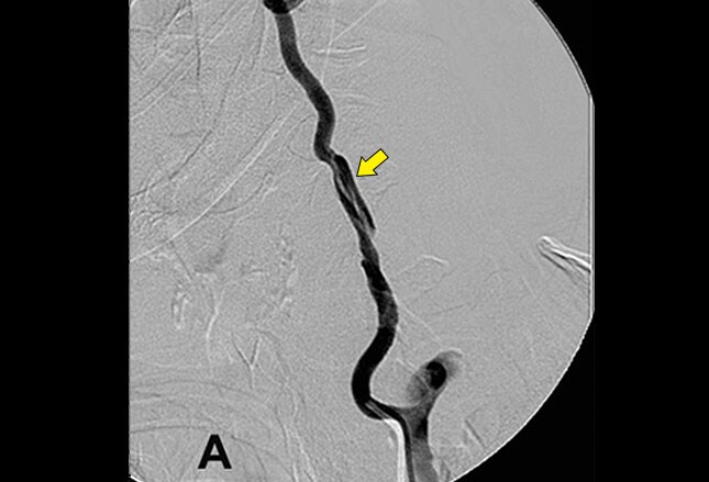 Central Vertigo: Identifying the Hidden Cause
