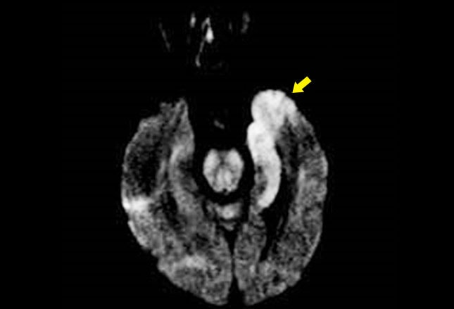 Central Vertigo: Identifying the Hidden Cause