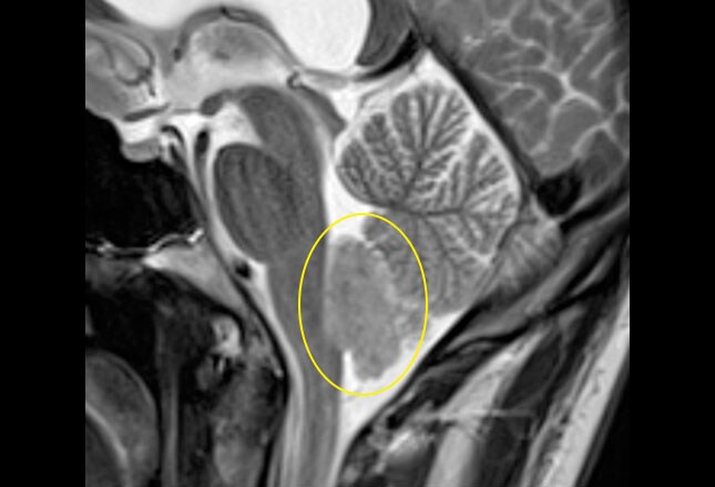 Central Vertigo: Identifying the Hidden Cause