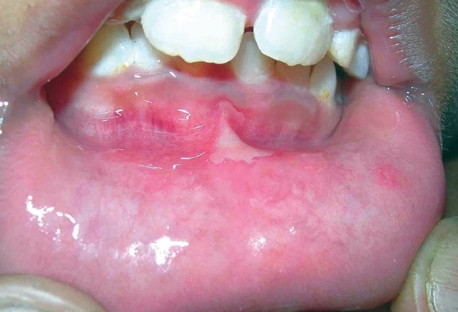 Cutaneous and Mucosal Manifestations of Viral Diseases