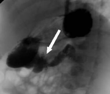 Pediatric Duodenal Atresia Treatment & Management: Medical Therapy ...
