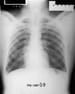 Silicosis Treatment & Management: Medical Care, Surgical Care, Prevention
