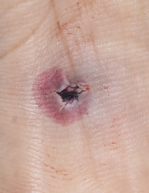 Forensic Pathology of Firearm Wounds: Overview, Modern Ammunition ...