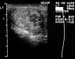 Scrotal Trauma: Practice Essentials, Relevant Anatomy, Etiology
